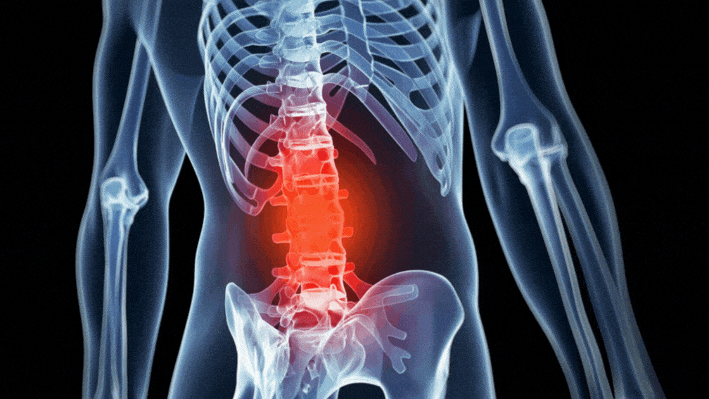 Compression Fractures - New England Endovascular Center