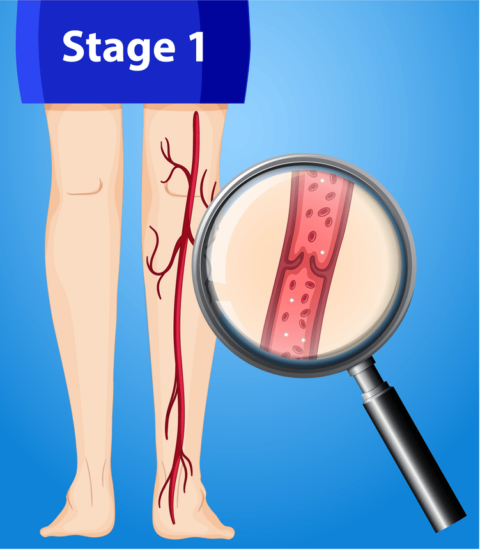 Deep Vein Thrombosis - New England Endovascular Center