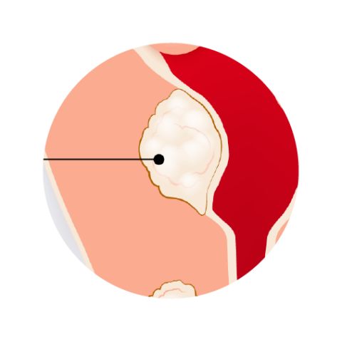 Uterine Fibroids - New England Endovascular Center