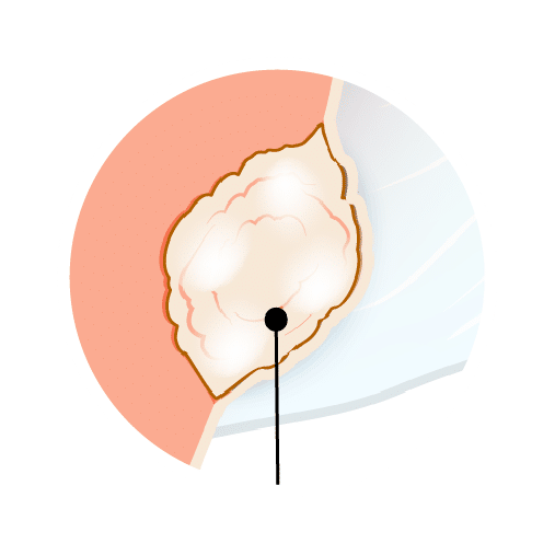 Uterine Fibroids - New England Endovascular Center
